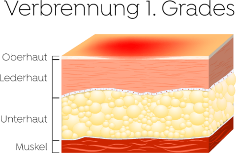 Verbrennungen & Brandblasen: Was tun? | octenisept®